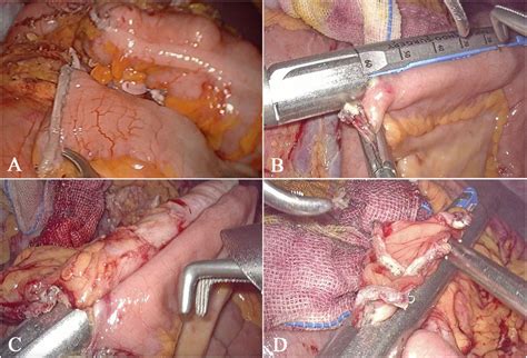 Procedures Of Antiperistaltic Sssa The Terminal Ileum And Transverse