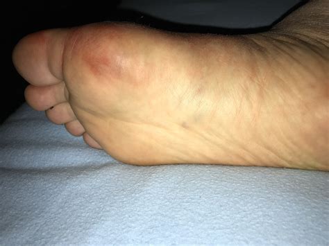 Sesamoidectomy 3 5 Weeks Post Op The Bendy Life