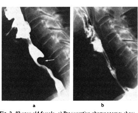 Figure 2 From Radiographic Findings After Cricopharyngeal Myotomy