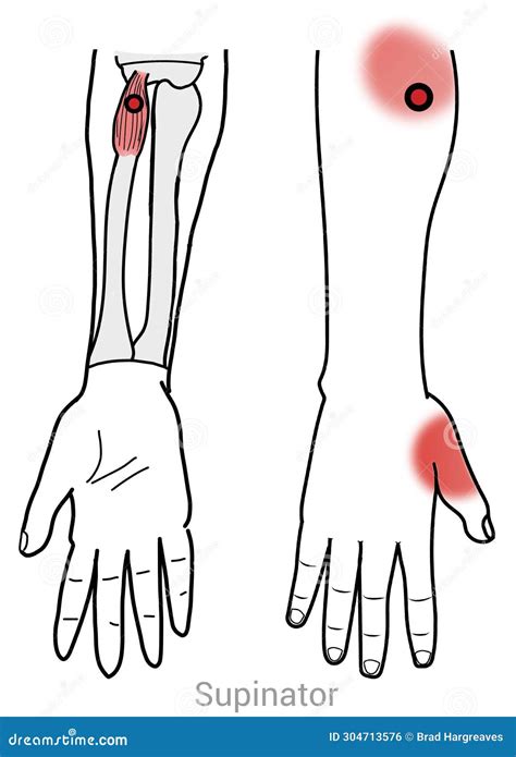 Myofascial Trigger Points Cartoon Vector 309901769