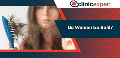 Do Women Go Bald Clinicexpert