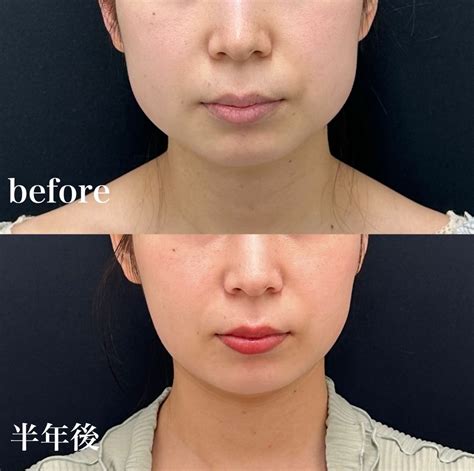 【バッカルファット除去は下部のみ】 下膨れに見えるのを改善したい方がよく検討されるバッカルファット除去。 取りすぎるとコケてしまうリスクも😢