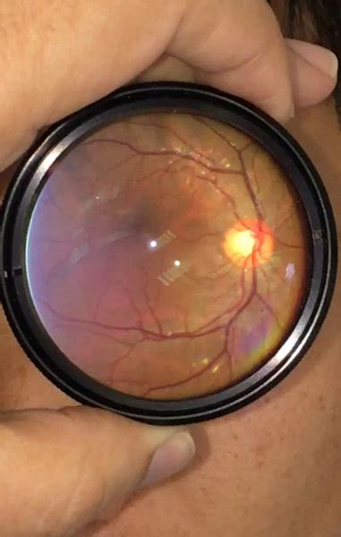 A Normal Macula And Optic Nerve Imaged Using A Smartphone Please Click