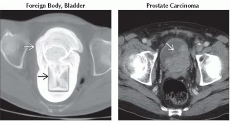 Da17 Db1 Fillingdefectinurinarybladder Ffu9 Abdominal Key