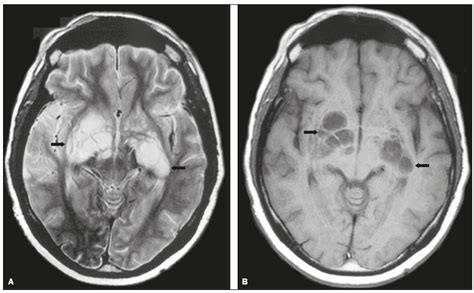 Radiologia Brasileira Magnetic Resonance Imaging Findings In Central