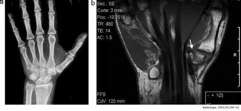 Análisis Del Manejo De Fracturas Ocultas De Escafoides Mediante La