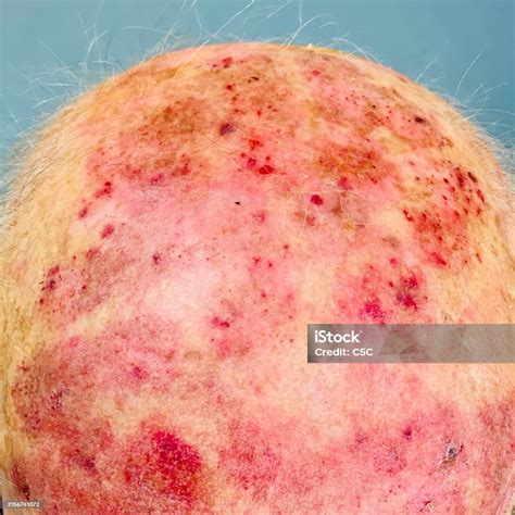 Queratosis Actínica Queratosis Solar Queratosis Senil Foto De Stock Y