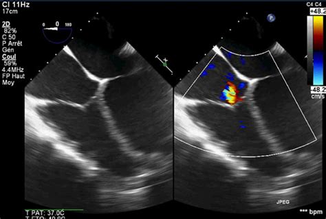 Left Ventricular Assist Device Implantation Induced Tricuspid Valve