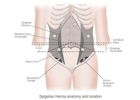 Spigelian Hernia Pictures Anatomy Symptoms And Repair