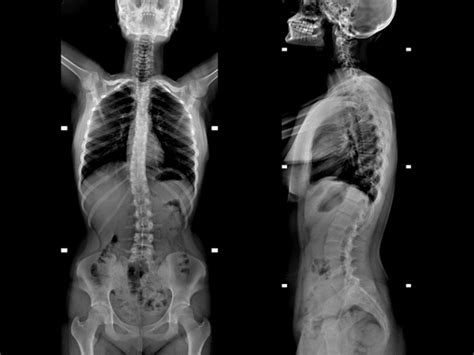 Skolyoz Grafisi İyitem Görüntüleme Merkezi