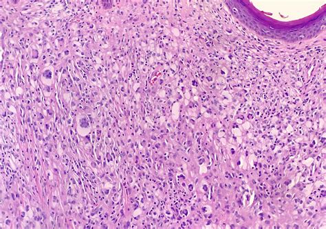 Juvenile Xanthogranuloma Histology