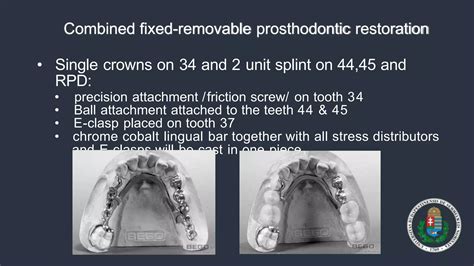 Removable Partial Denture F Fpptx