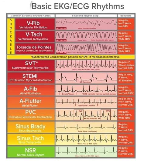 Saqib Waheed On Linkedin Basic Ecg Rhythms