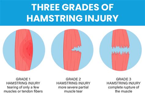 Pulled Hamstring Grade 1