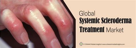 Key Competitors Systemic Scleroderma Treatment Industry
