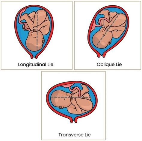 Cephalic Longitudinal Lie