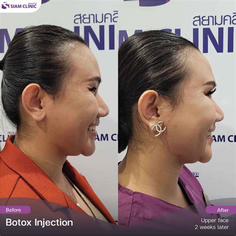 Botox Injection Sites