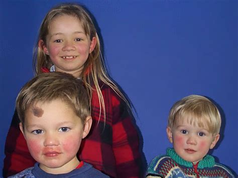 Viral Rash 9 Types Causes Symptoms And Treatment