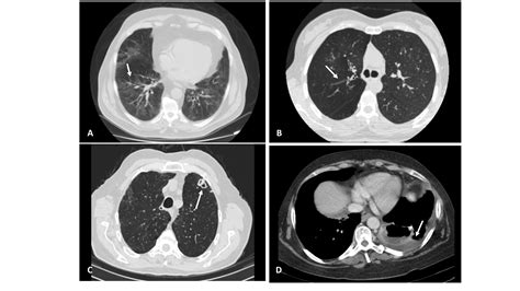 Prevalence And Predictors Of Mortality In Rheumatoid Arthritis Related Lung Disease Results