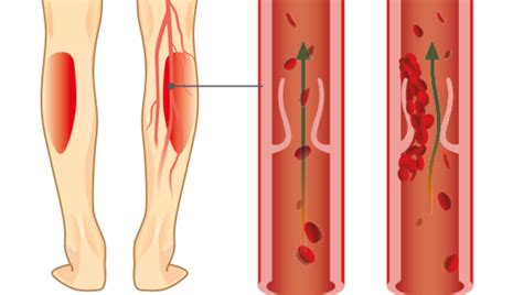 Thrombose Prophylaxe 8 Tipps Für Den Venenfreundlichen Alltag Angehörige Pflegen
