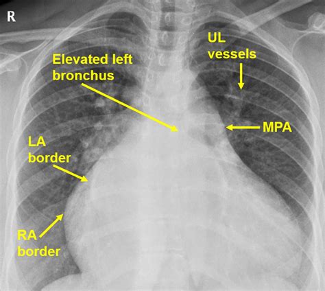 Cephalization Of Pulmonary Vessels