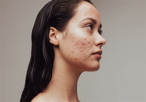 Acne Core Dermatology