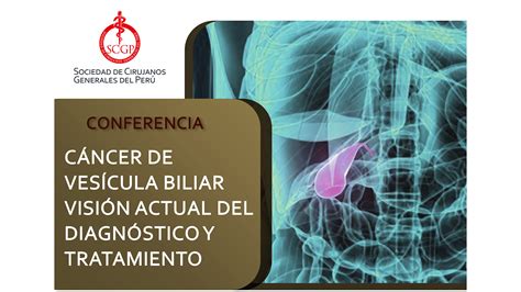 CÁncer De VesÍcula Biliar VisiÓn Actual Del DiagnÓstico Y Tratamiento