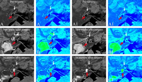A Comparison Of Endolymphatic Duct Blockage Endolymphatic Sac Drainage