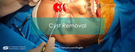 Huge Nasal Polyps Removal By Dr Shahriyar Yahyavi Dr Shahriyar Yahyavi