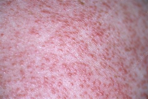 Pityriasis Rubra Pilaris Photos Clsa