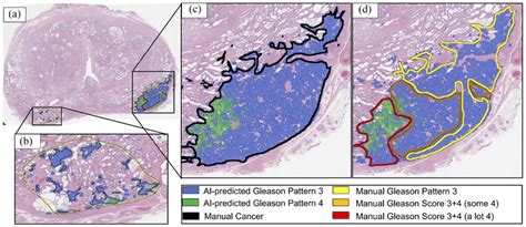 The Ai Predicted 60 Automated Aggressive Gleason Pattern 4 Green And Download Scientific