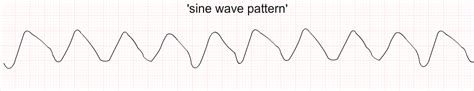 Hyperkalemia Ecg Sine Wave