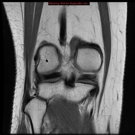 Radiopaedia Case Recent Patella Dislocation Mri Id 16716 Study