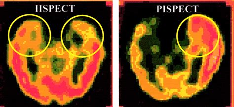 The Relative Localizing Value Of Interictal And Immediate Postictal