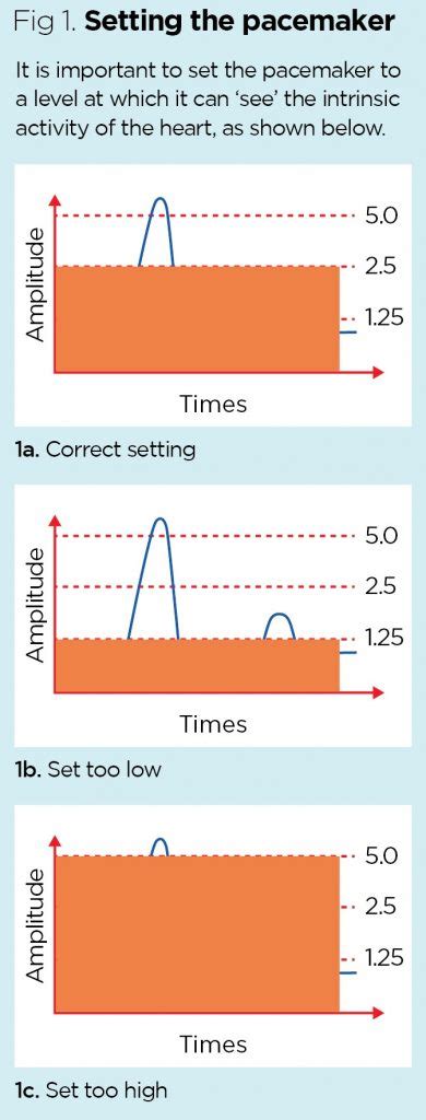 Pacemaker Therapy 2 Pacing Functions And Their Role In Patient Care Nursing Times