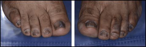 The Right And Left Feet Show Hyperpigmentation Of The Toenails The