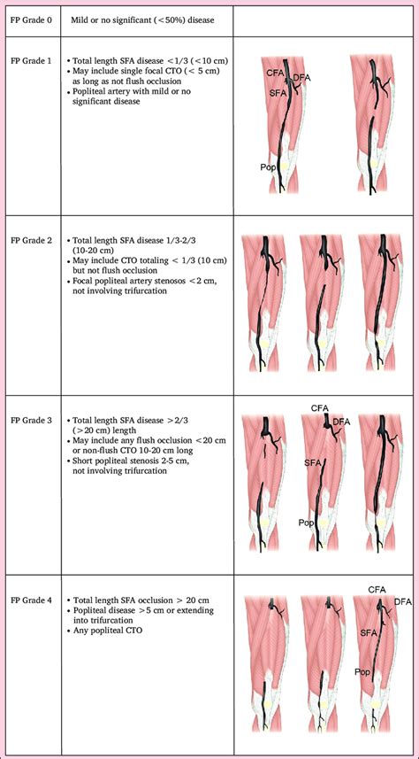 2 Femoropopliteal Fp Disease Grading In Global Limb Anatomic Staging