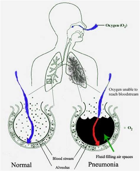 Sputum Physiopedia