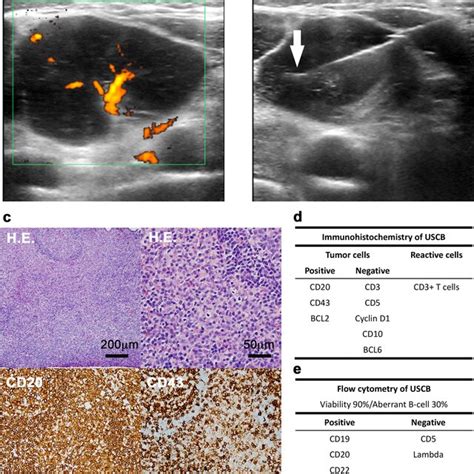 Marginal Zone Lymphoma Diagnosed By The Ob Samples A Right