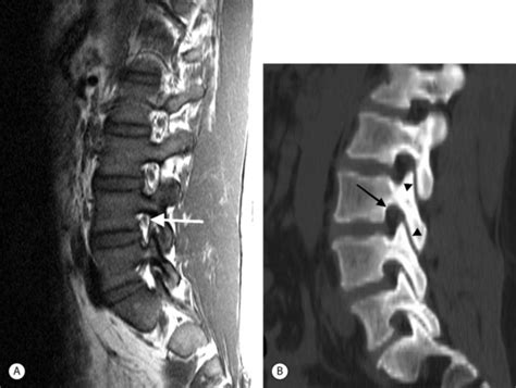 L5 Neural Foramen