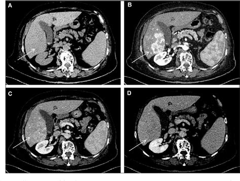 Figure 3 From Enhancement Patterns Of Intrahepatic Mass Forming Cholangiocarcinoma At