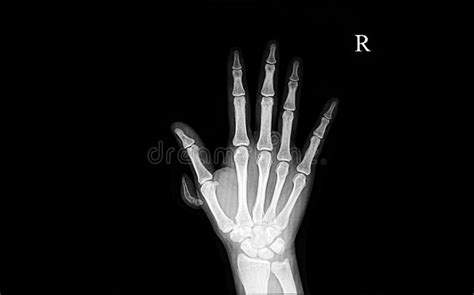 Polydactyly On Human Rare Abnormal Characteristic Causes By Chromosome