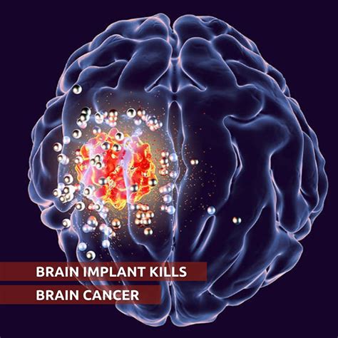 Dianox On Linkedin Medical Braincancer Cancerresearch Implant Science Innovation