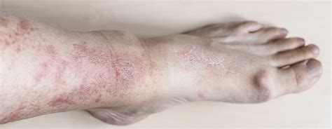Cómo Curar La Psoriasis En Los Pies Farmacias Carrascosa