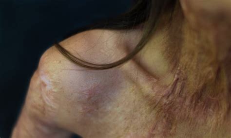 Burn Scar Treatment Functional Kinematics And Modern Therapies