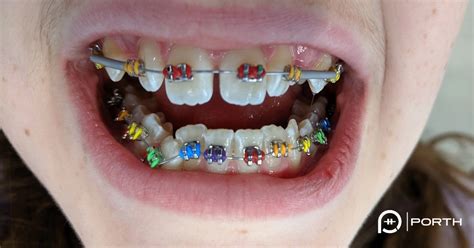 Colorful Braces