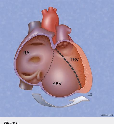 Figure 1 From Ebsteins Anomaly Semantic Scholar