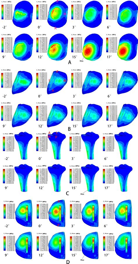 Finite Element Analysis Of Sagittal Angles Of Unicompartmental Knee Arthroplasty Clinical