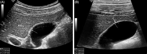 Gallbladder Ultrasound Transverse