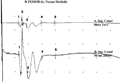 Motor Ncs Study On 21st Postoperative Day Motor Potential Registered